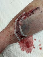 How to Repair a Facial Laceration Like a Plastic Surgeon